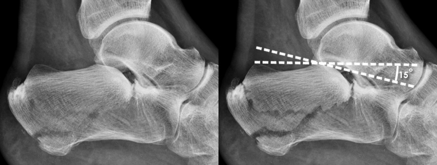 Calcaneus Fracture X Ray Calcaneus Fracture X Ray