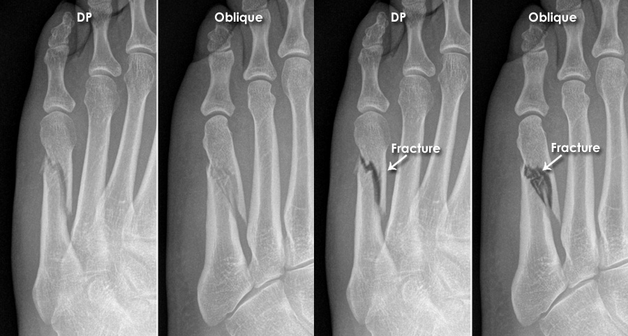 Metatarsal Bone Fracture