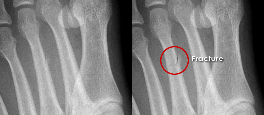 Xray Of Foot Stress Fracture