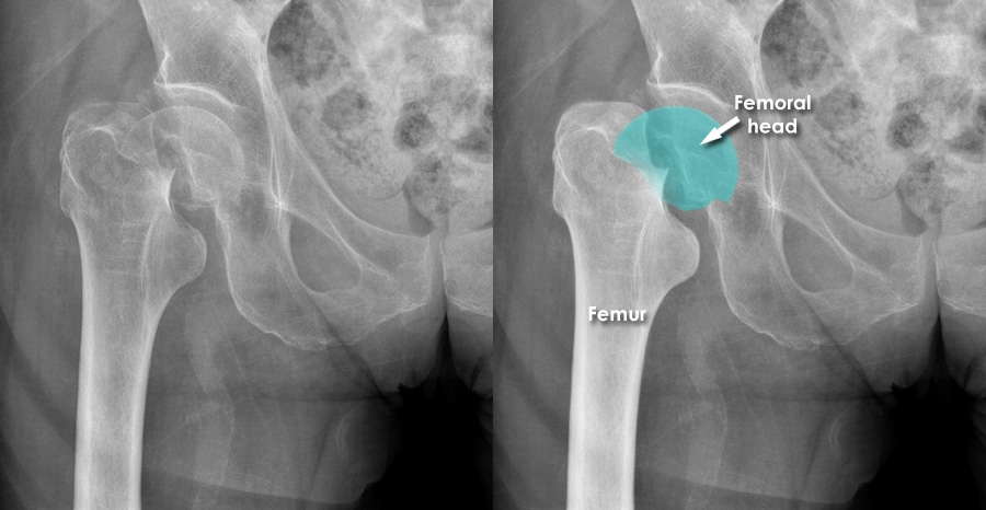 Subcapital Femoral Neck Fracture