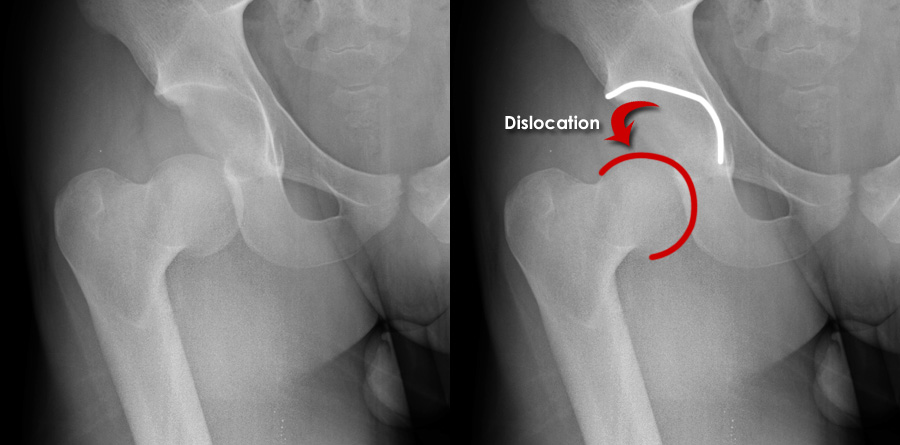 Trauma X-ray - Lower limb gallery 1 - Hip - Dislocation