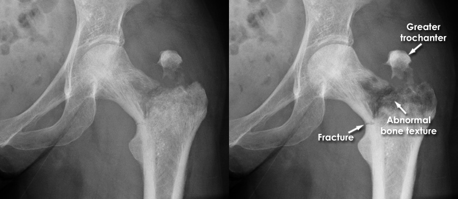 Pathologic Fracture X Ray Pathologic Fracture What It Is Causes