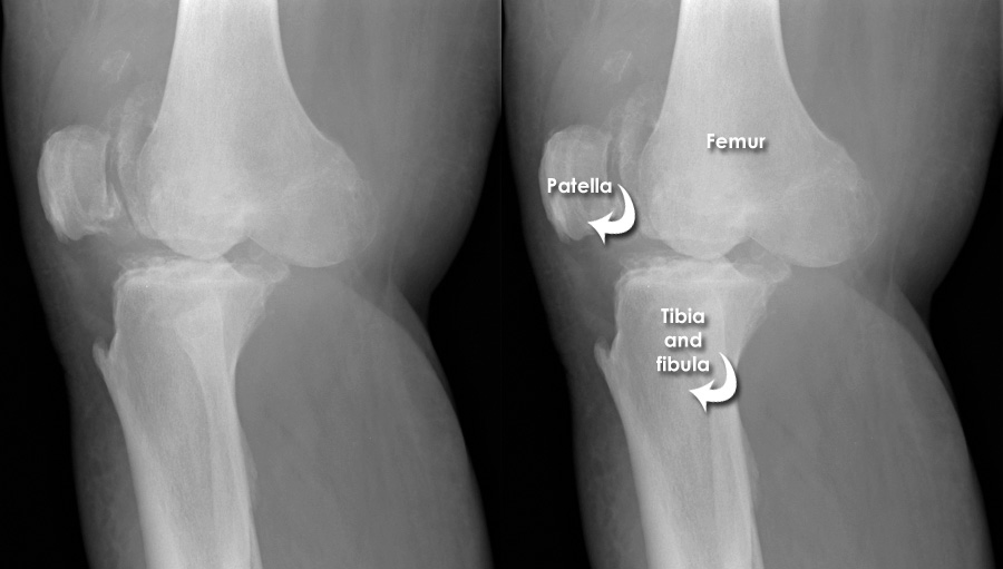 Knee Patellar Dislocation X Ray