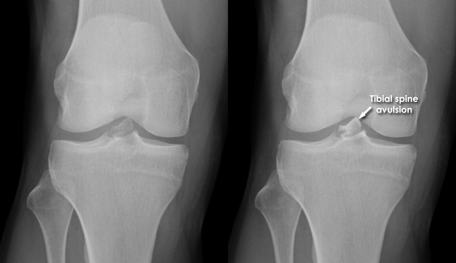 Trauma X-ray - Lower limb gallery 1 - Knee - Other injuries