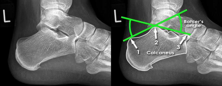 Trauma X-ray - Lower limb - Calcaneus