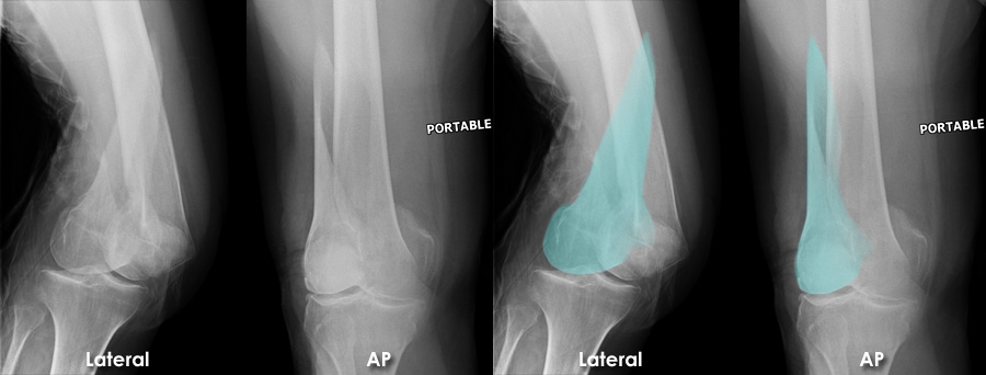 Compound Femur Fractures