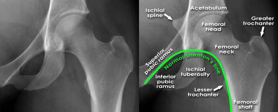 Hip Fracture