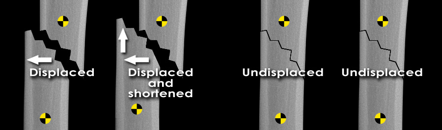 Introduction to Trauma X-ray - Fracture displacement