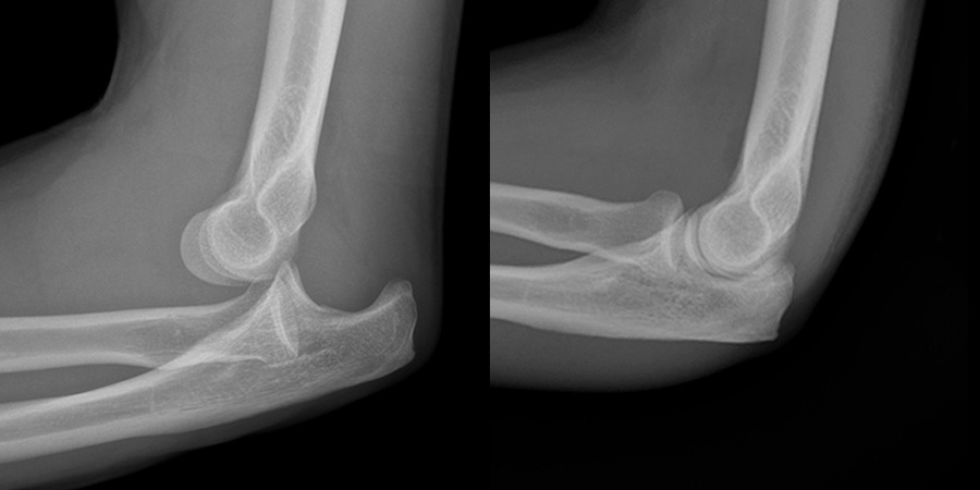 Elbow X Ray Fracture