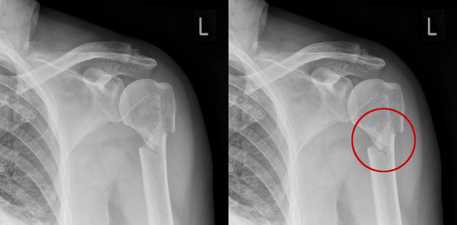 Humerus X Ray Intraoperative Imaging Of The Proximal Humerus