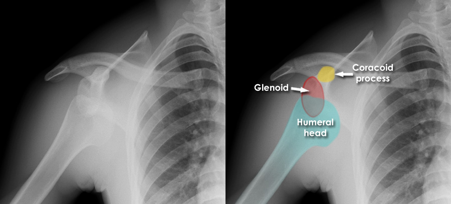 Anterior Shoulder Dislocation Anterior Shoulder Dislocation