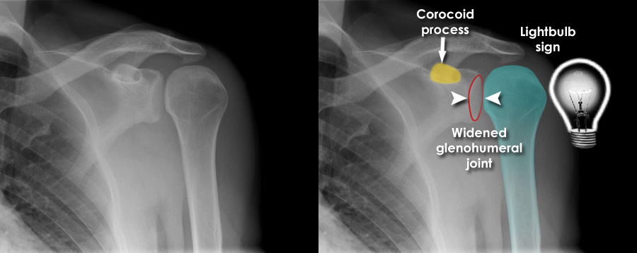 Anterior Vs Posterior Shoulder Dislocation Xr Anterior Vs Posterior Shoulder Dislocation Xr