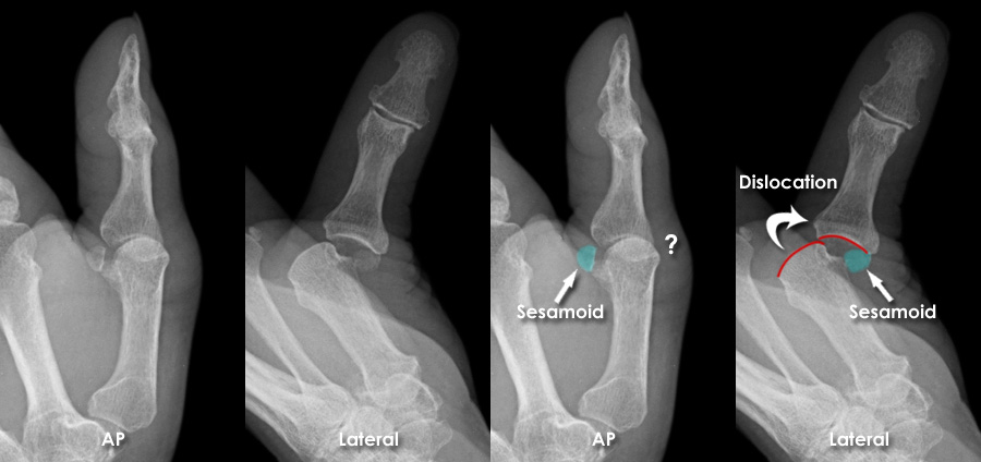 Dislocated Finger X Ray