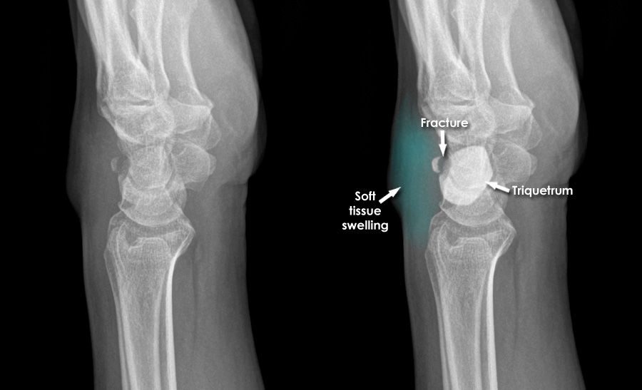 Triquetral Approach To Chronic Wrist Pain In Adults The College Of triquetral-approach-to-chronic-wrist-pain-in-adults-the-college-of