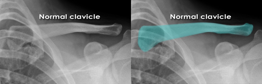 Normal Clavicle Xray The Clavicle: Normal And Abnormal.