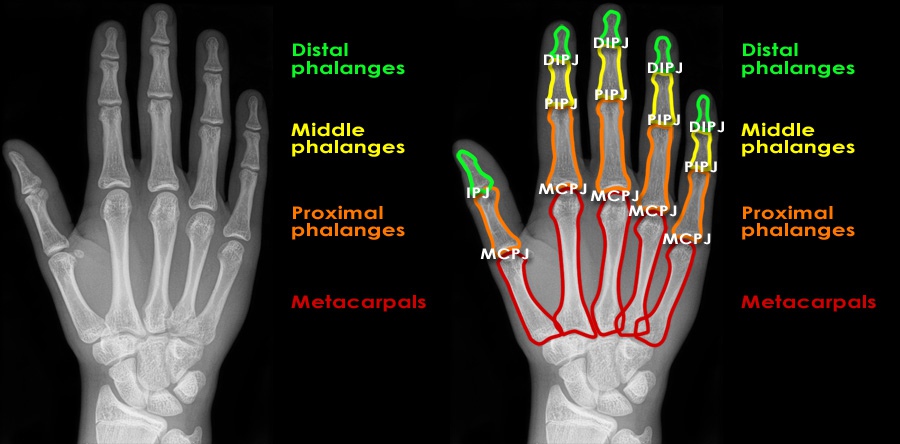 Hand Xray