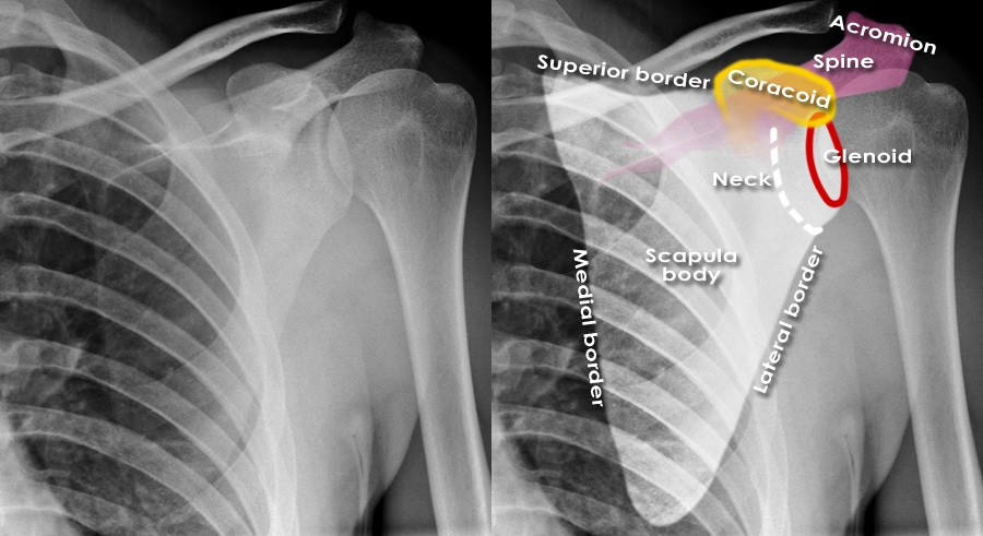 Lateral Scapula X Ray