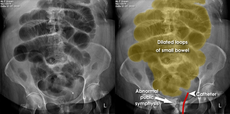 Plicae Circulares X Ray
