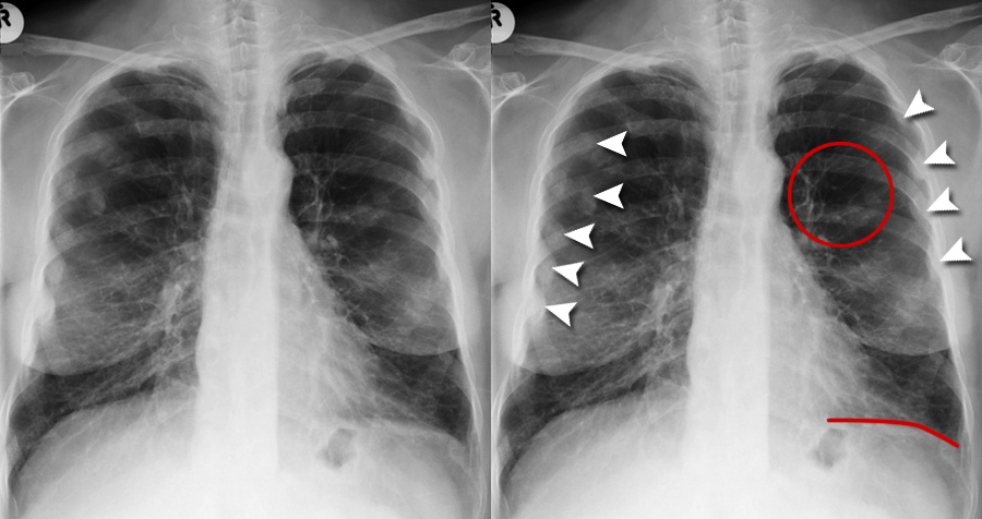 Chest X-ray - Scenario 4 - Scenario image interpretation